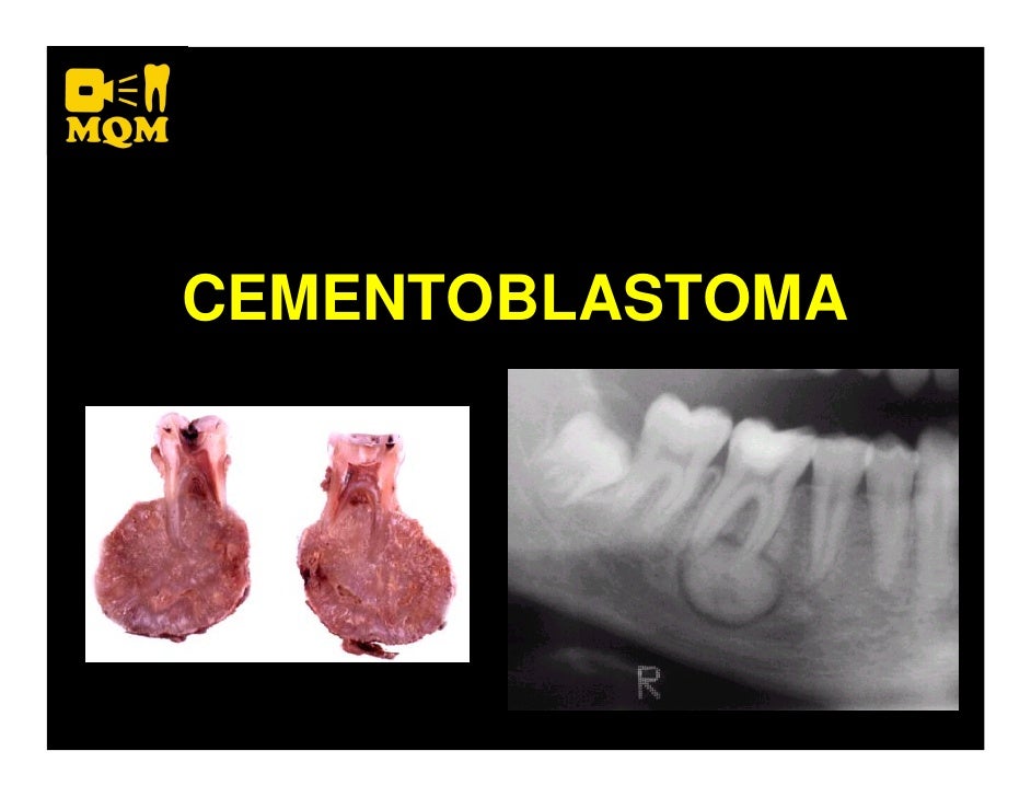 Cementoblastoma