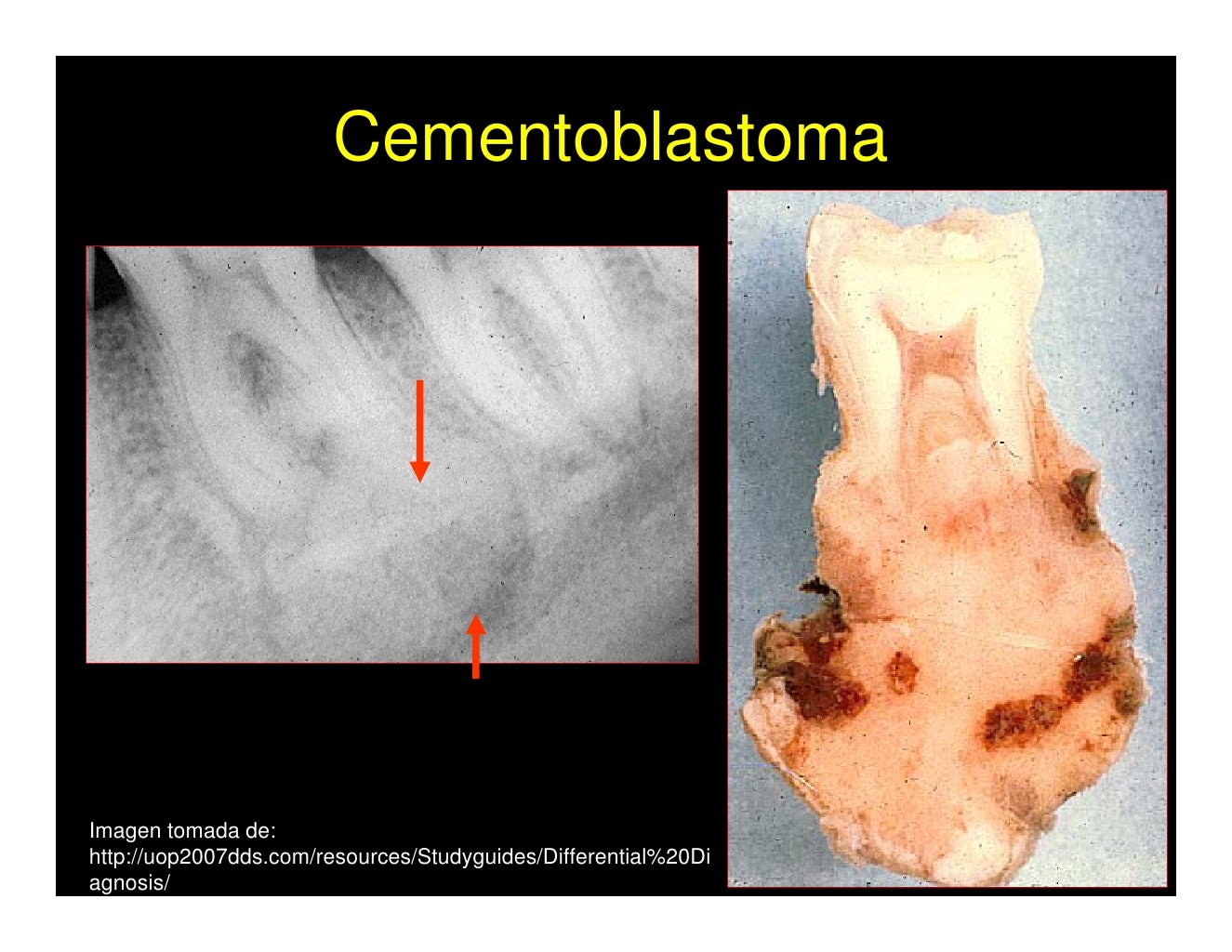 Cementoblastoma