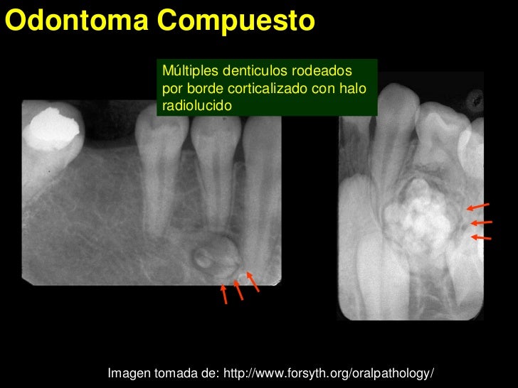 Odontoma