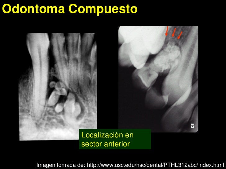 Odontoma