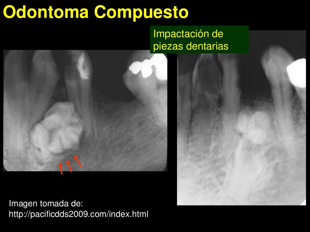 Odontoma