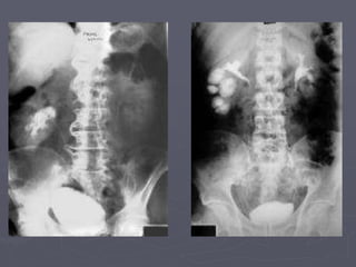 DUPLEX COLLECTING SYSTEM FOR DOCTORS .pptx