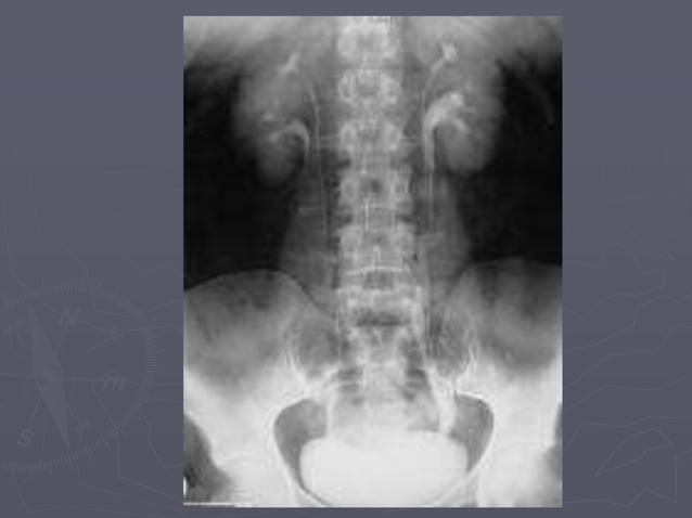 DUPLEX COLLECTING SYSTEM FOR DOCTORS .pptx