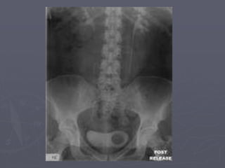 DUPLEX COLLECTING SYSTEM FOR DOCTORS .pptx