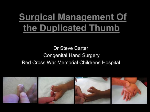 Duplicated thumb | PPT | Physical Therapy | Wellness
