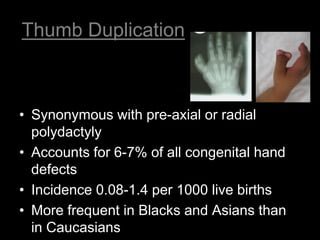 Duplicated thumb | PPT