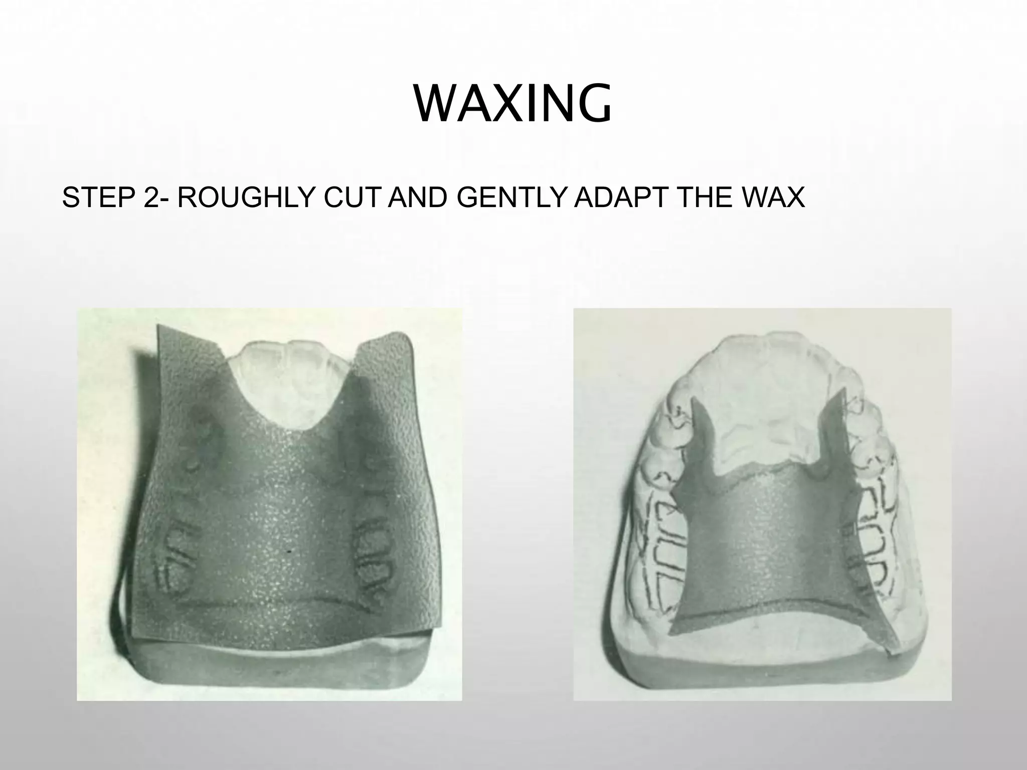 Duplication and wax up in rpd | PPT