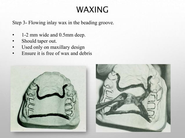 Duplication and wax up in rpd | PPT | Chemistry | Science