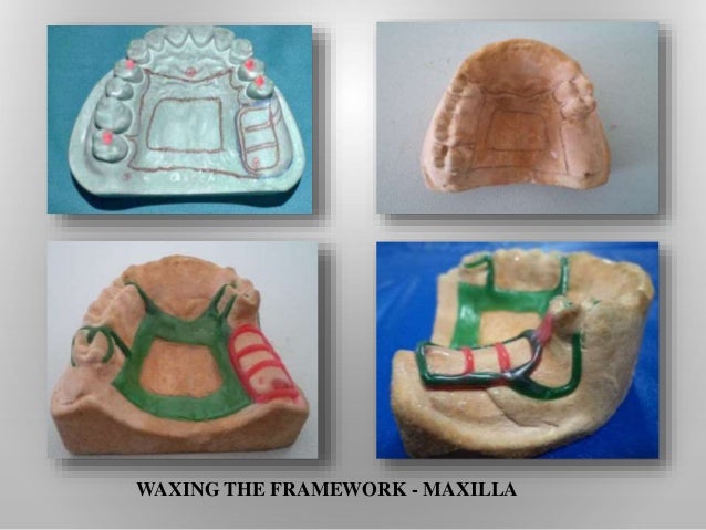 Duplication and wax up in rpd