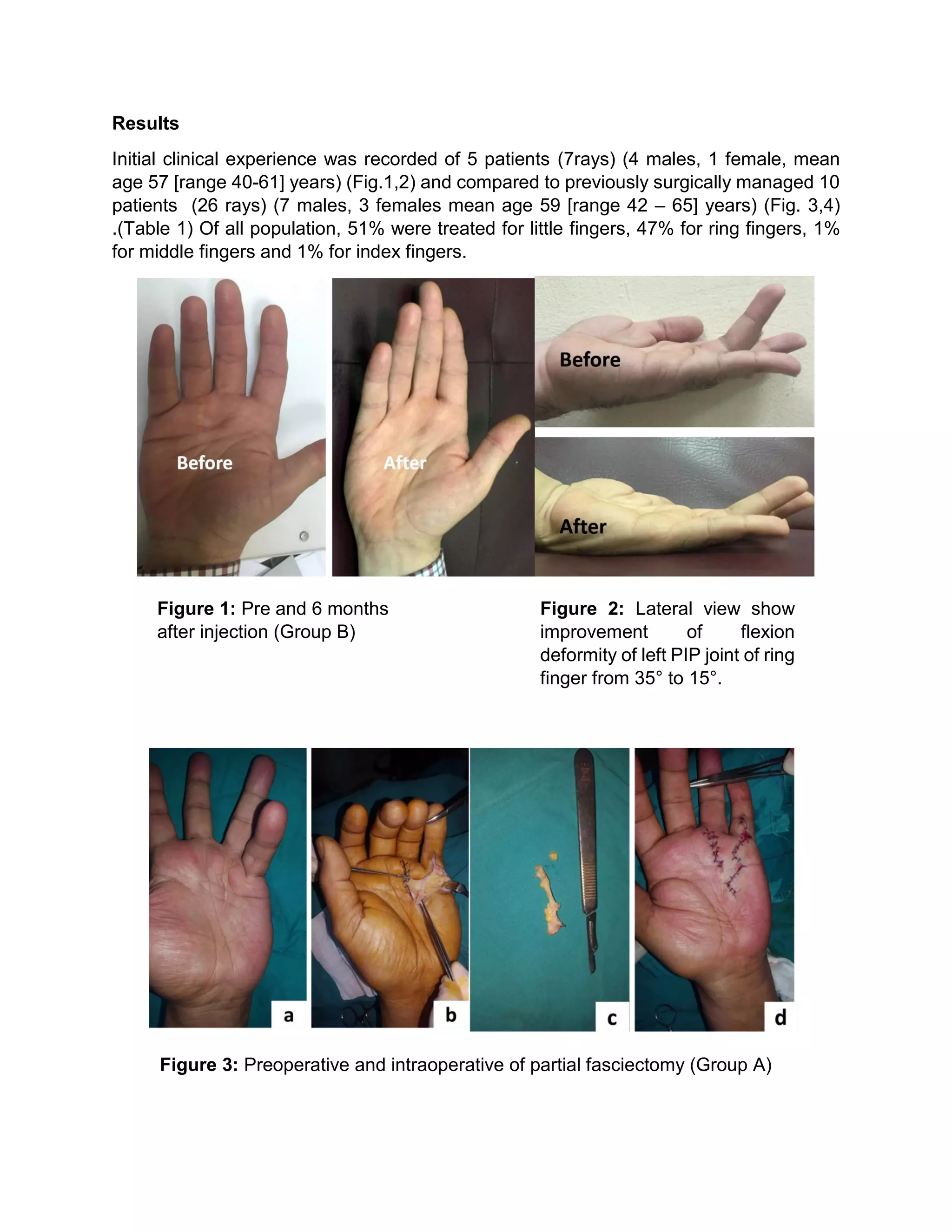 Efficacy of Injectable Collagenase in the treatment of Dupuytren’s ...