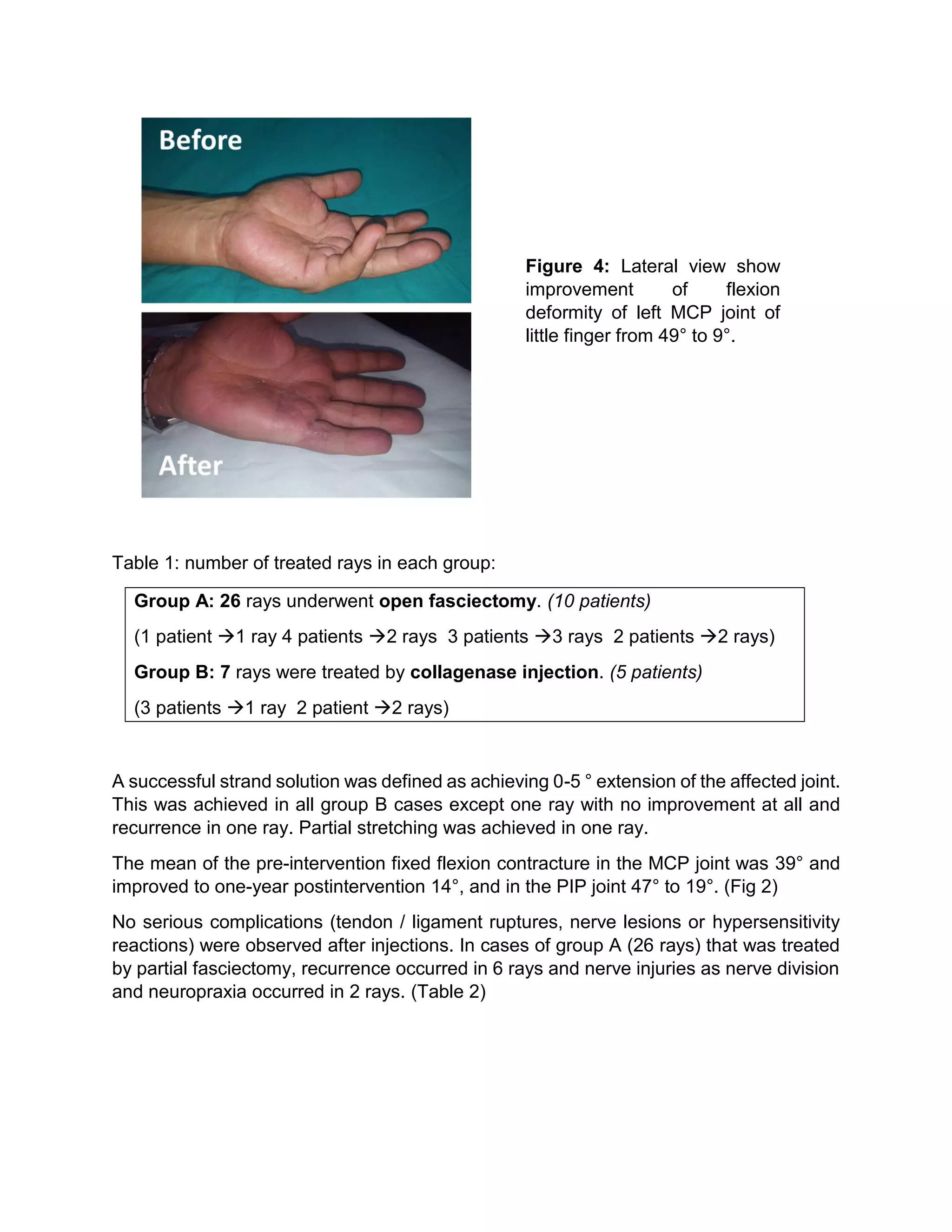 Efficacy of Injectable Collagenase in the treatment of Dupuytren’s ...