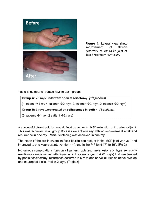 Efficacy of Injectable Collagenase in the treatment of Dupuytren’s ...