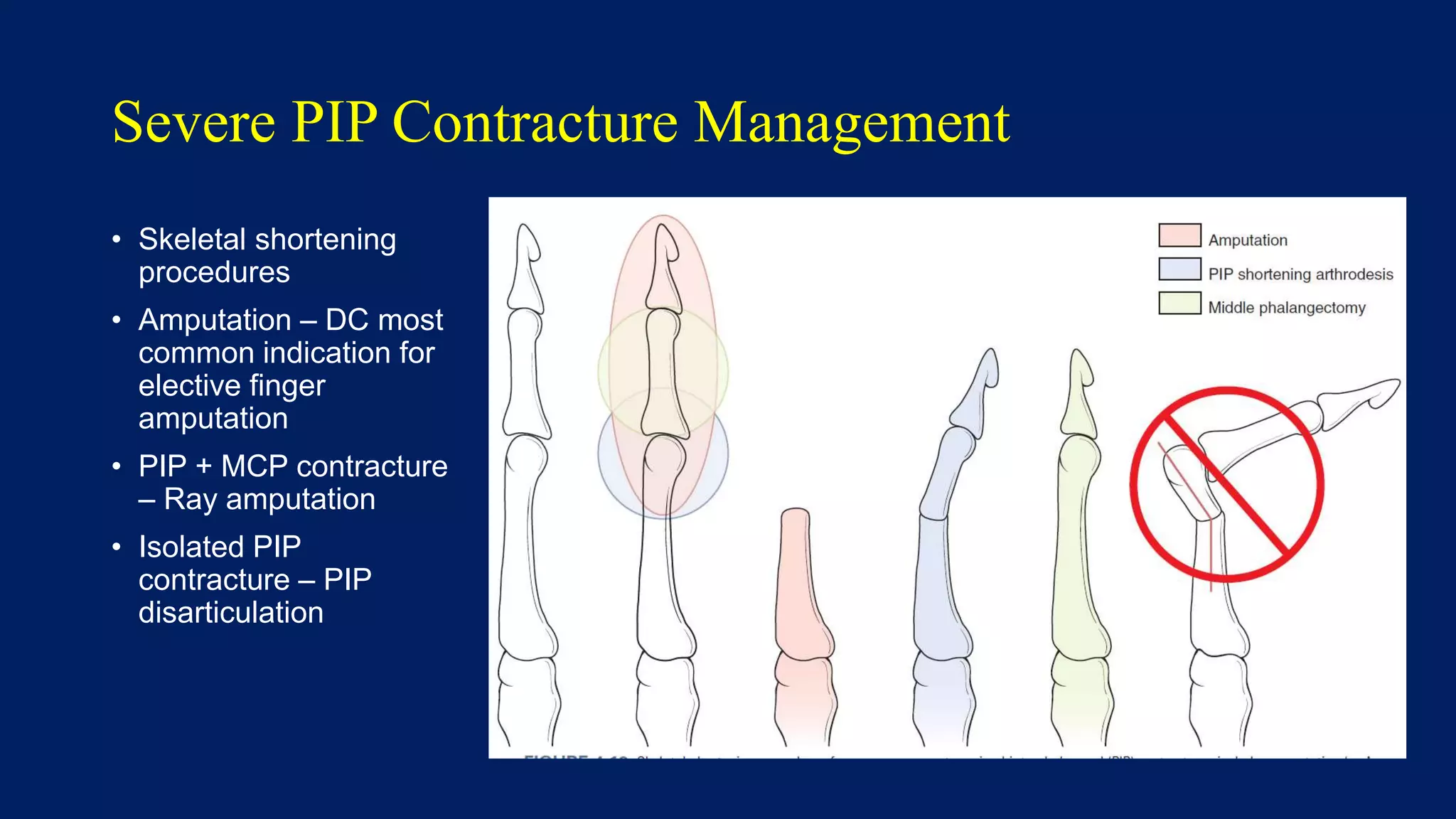 Dupuytren's contracture | PPTX