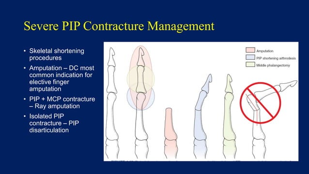 Dupuytren's contracture | PPTX | Diseases and Conditions | Medical Health