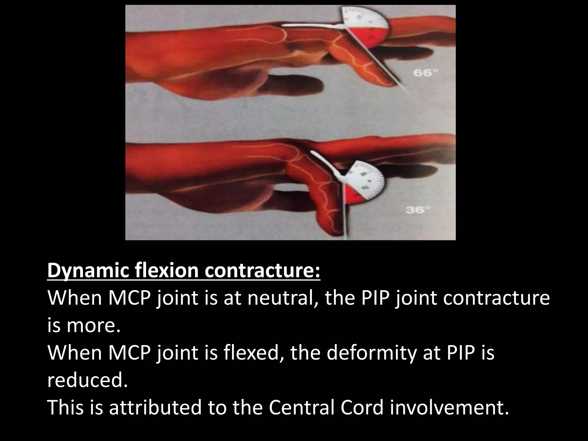 Dupuytrens Contracture | PPTX