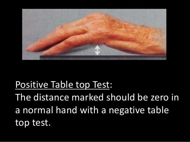 Dupuytrens Contracture