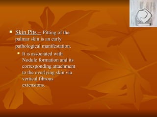 Dupuytrens Contracture | PPT