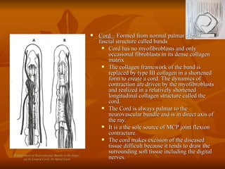 Dupuytrens Contracture | PPT