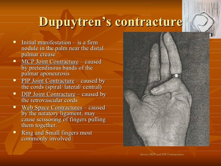 Dupuytrens Contracture