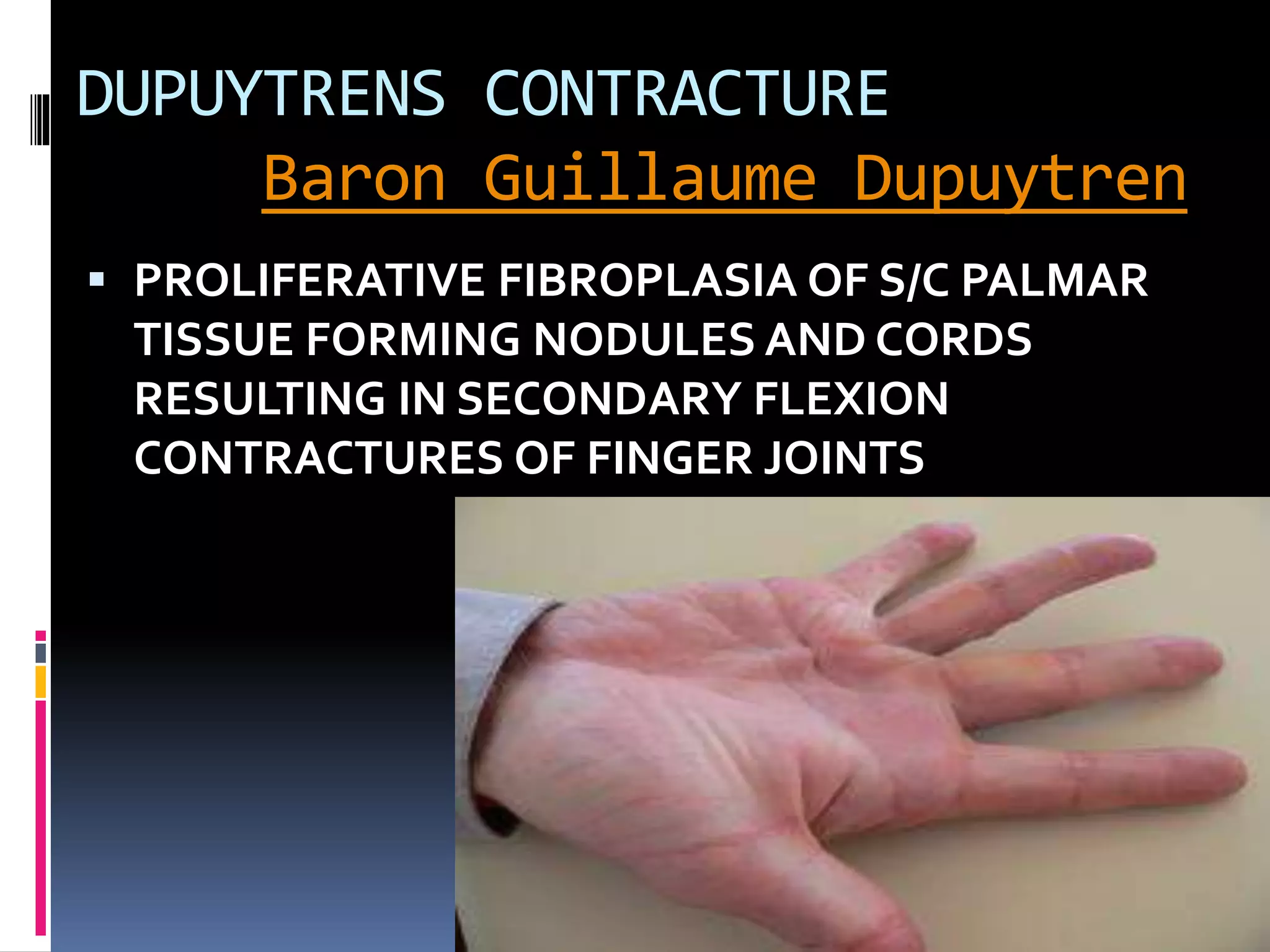 Dupuytrens contracture | PPTX