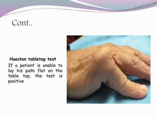 Dupuytrens contracture | PPTX