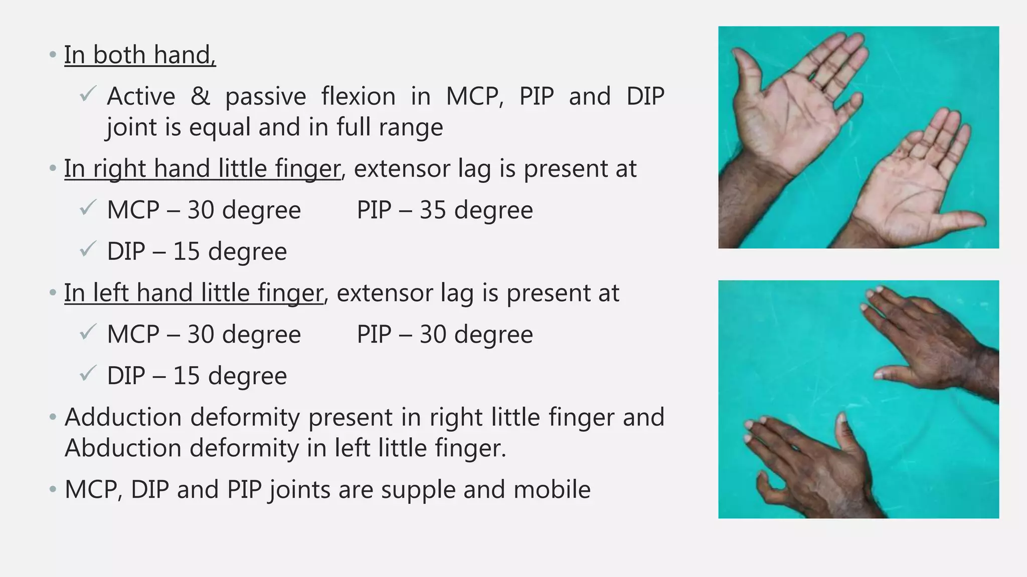 Dupuytren's contracture Plastiquest | PPT