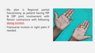 Dupuytren's contracture Plastiquest | PPTX