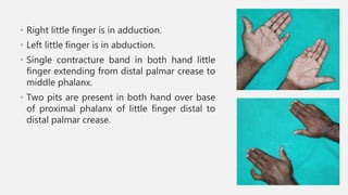 Dupuytren's contracture Plastiquest | PPT