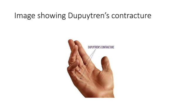 Dupuytrens contracture | PPT