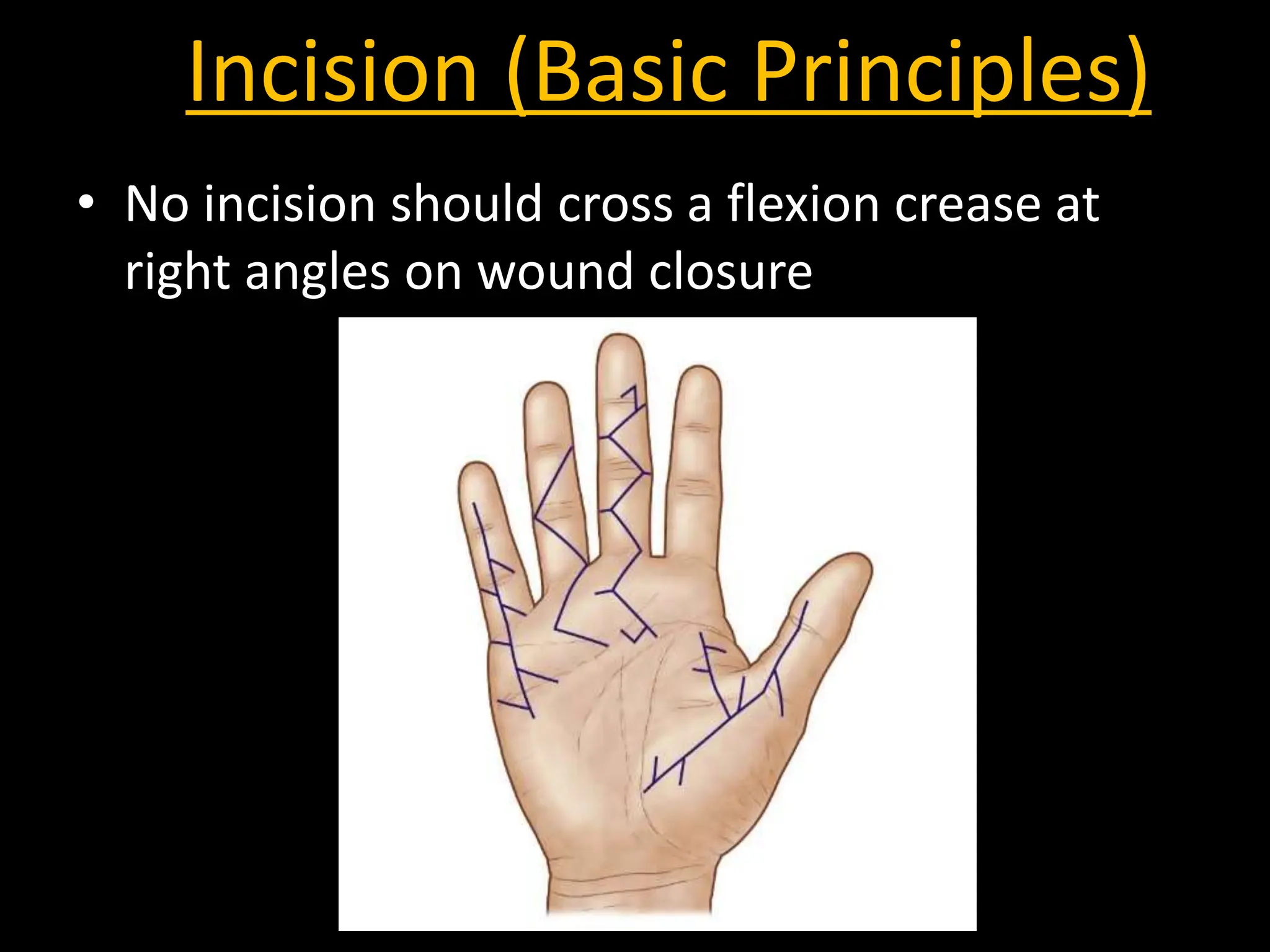 dupuytrens contracture and its intervention | PPTX