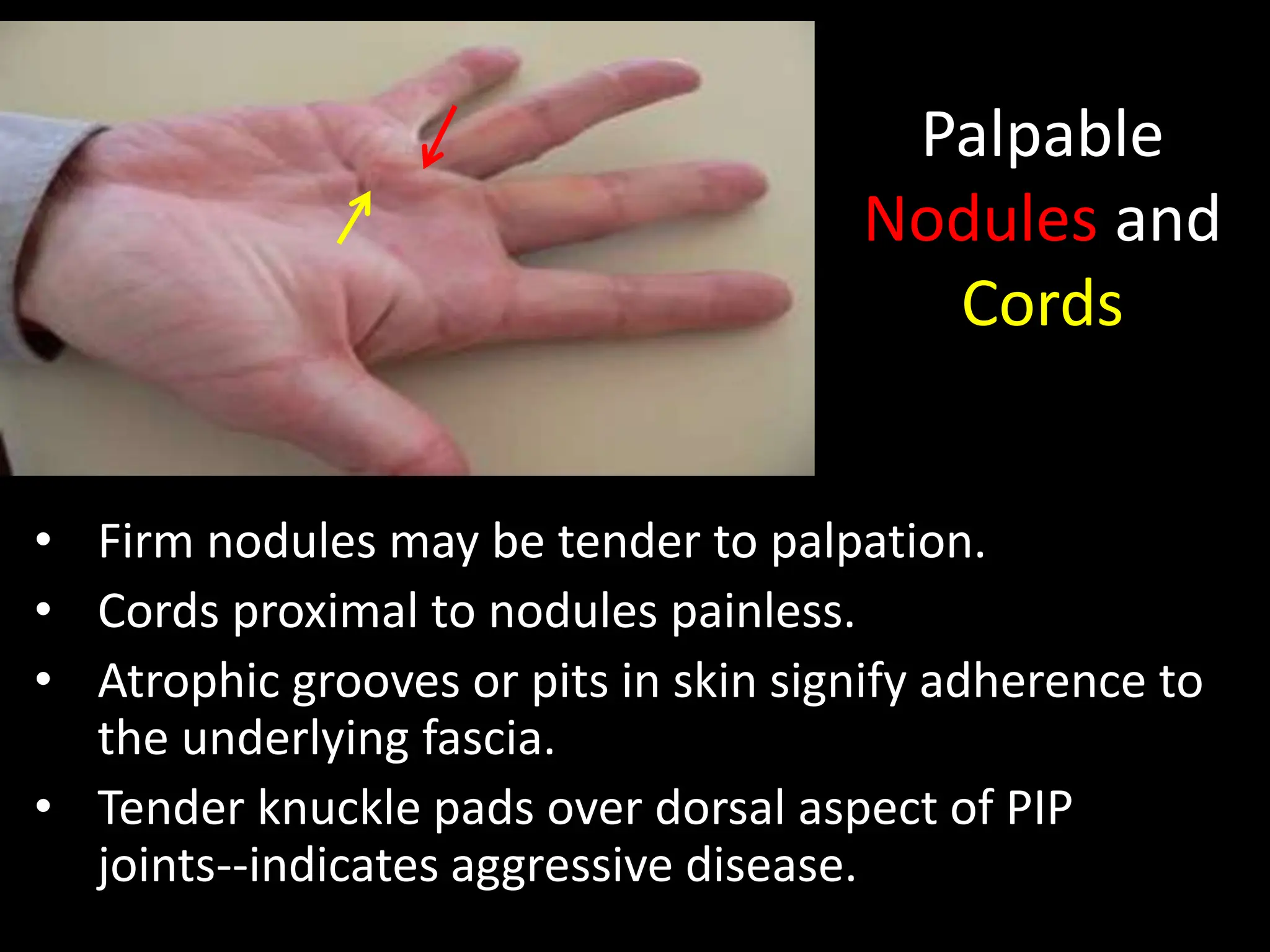 dupuytrens contracture and its intervention | PPTX