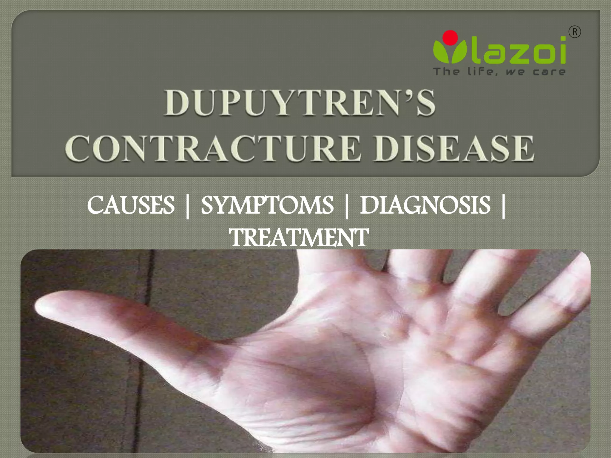 Dupuytren’s Contracture Disease : causes, symptoms and treatment | PPT