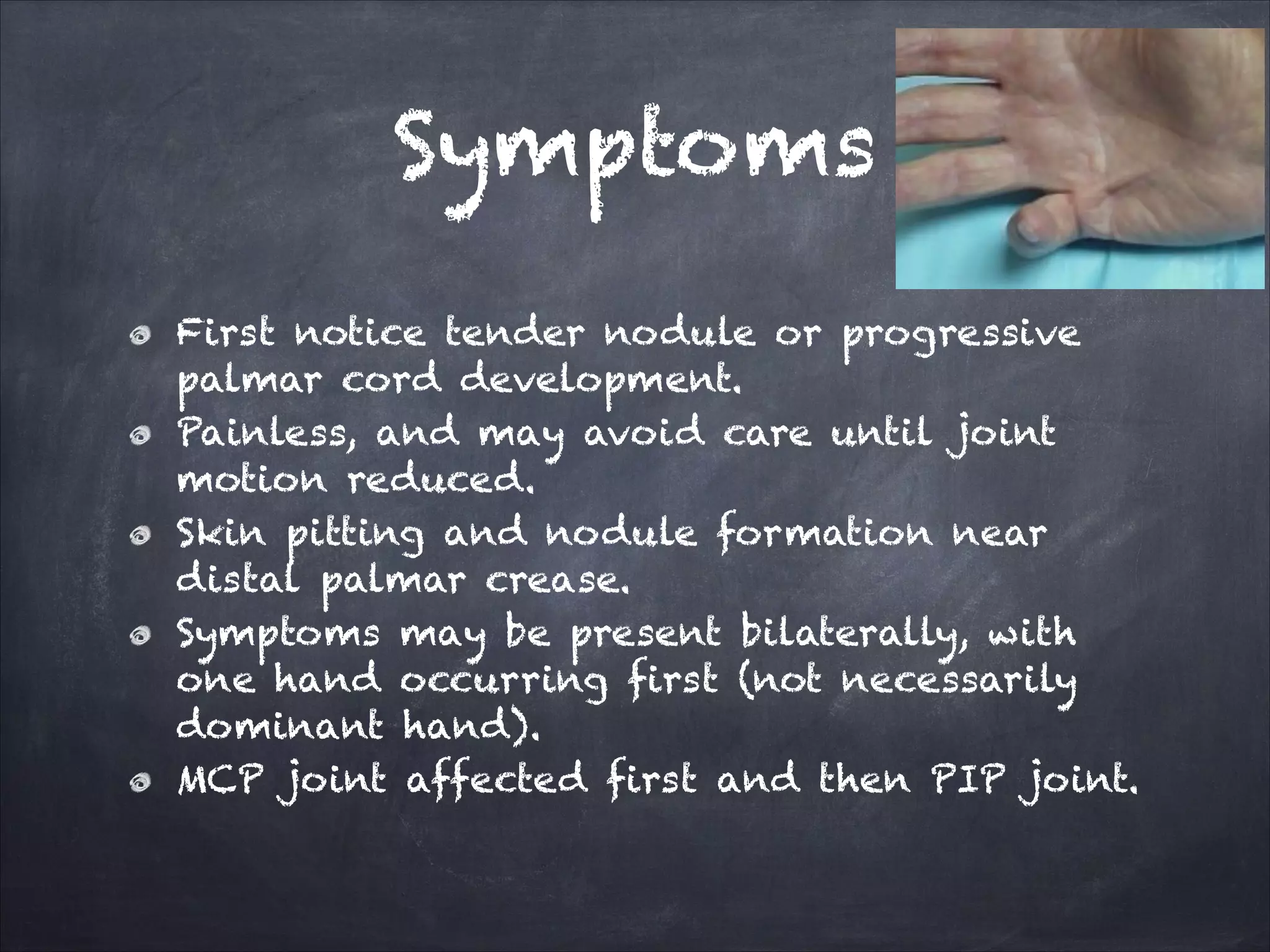 Dupuytrens contracture presentation | PDF