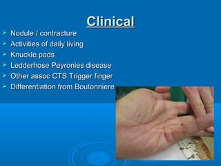 Dupuytrens disease | PPT