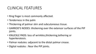 Dupuytrens disease | PPTX