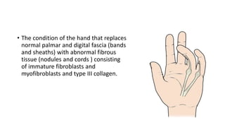Dupuytrens disease | PPTX
