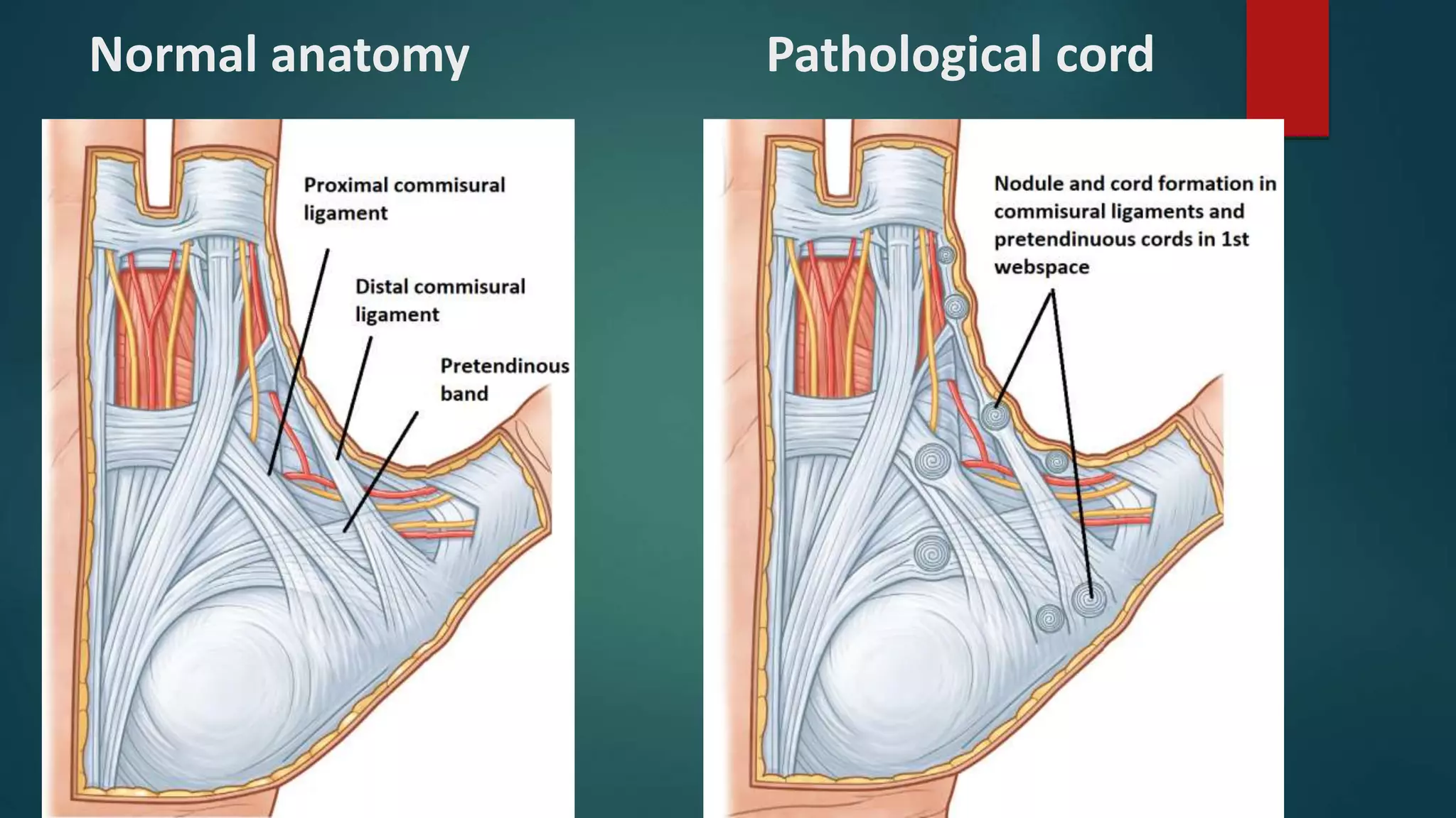 Dupuytren’s Disease.pptx