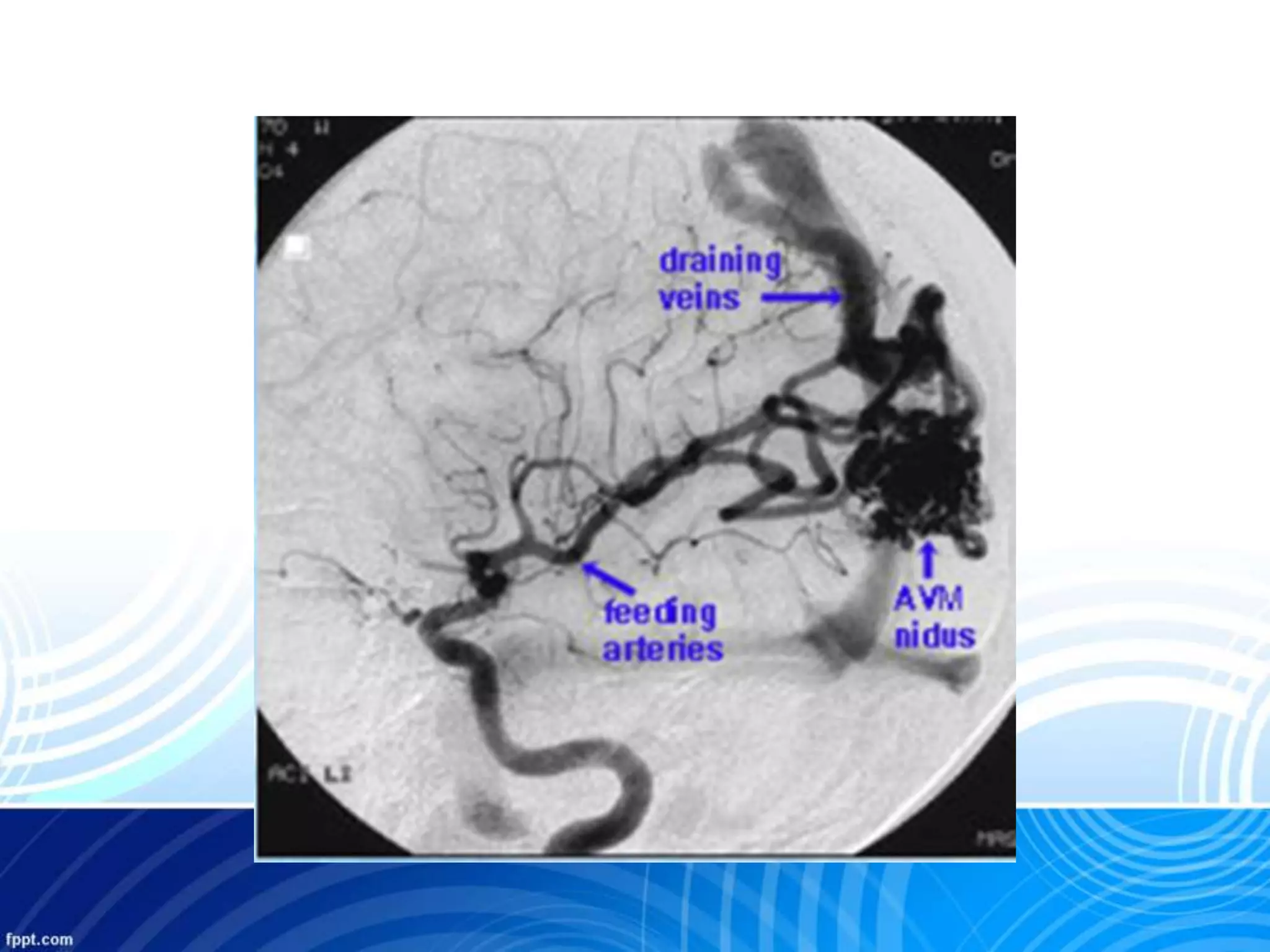 Dural arteriovenous fistula & AVM | PPT