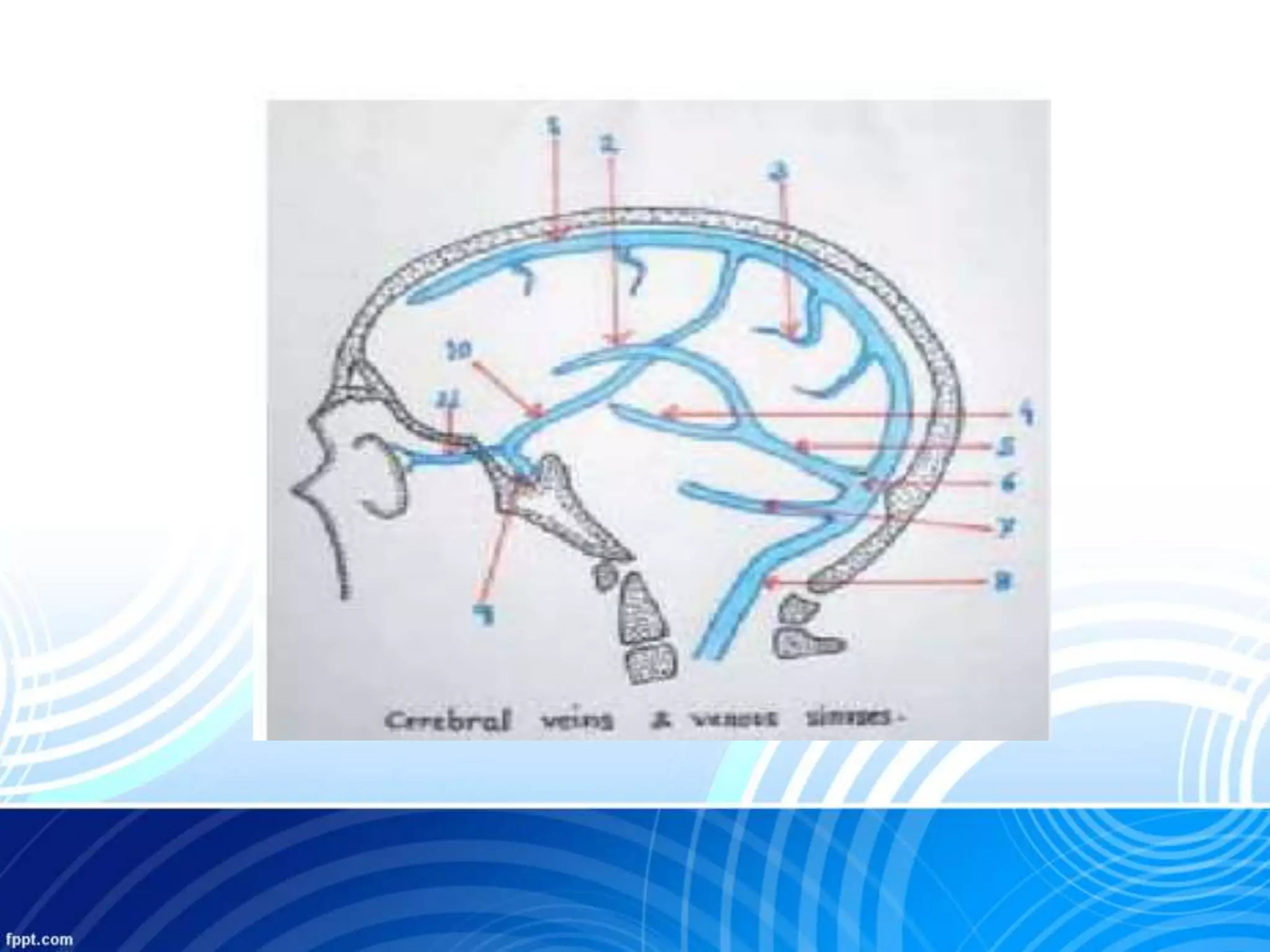 Dural arteriovenous fistula & AVM | PPTX