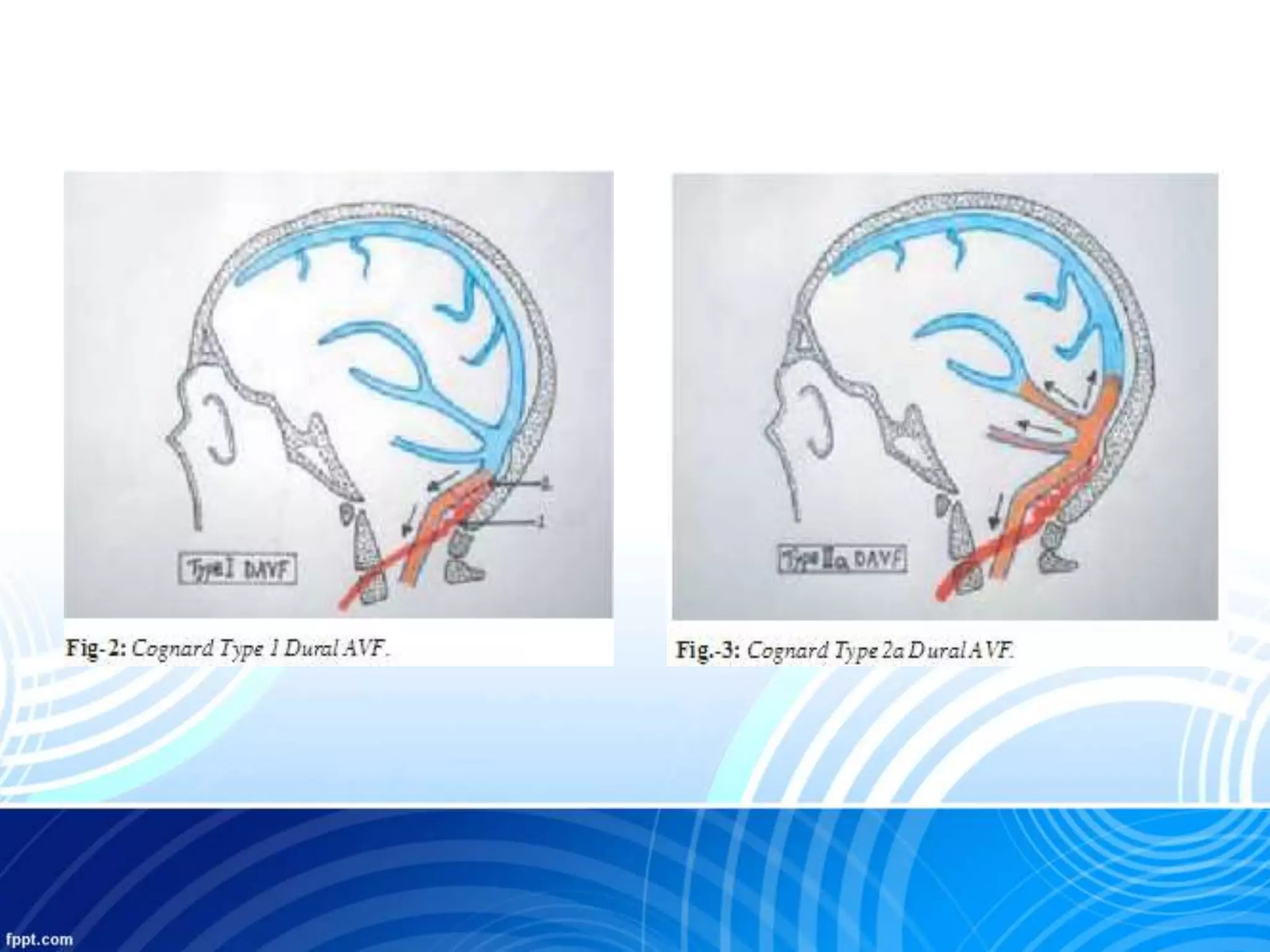 Dural arteriovenous fistula & AVM | PPT