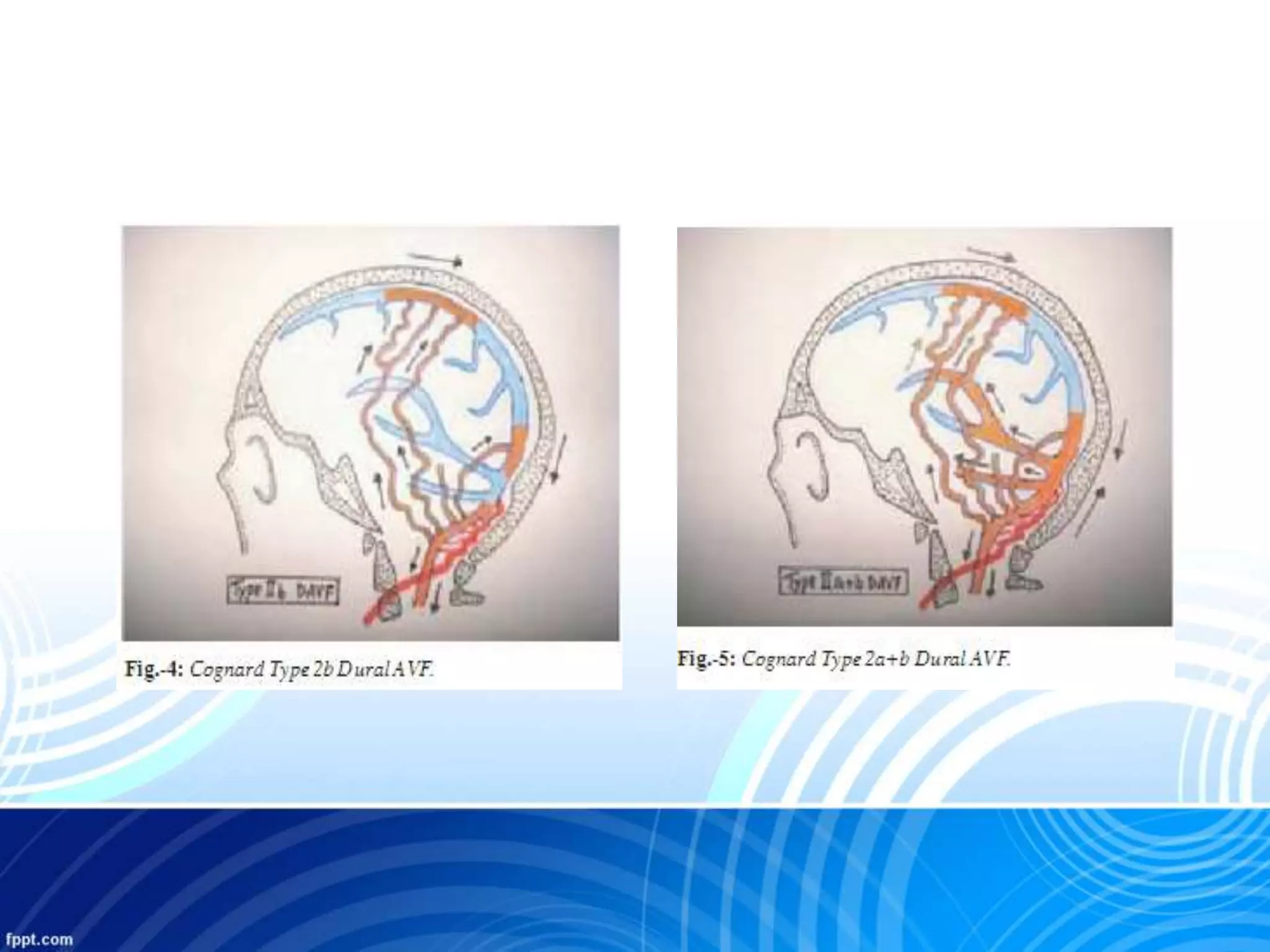 Dural arteriovenous fistula & AVM | PPTX