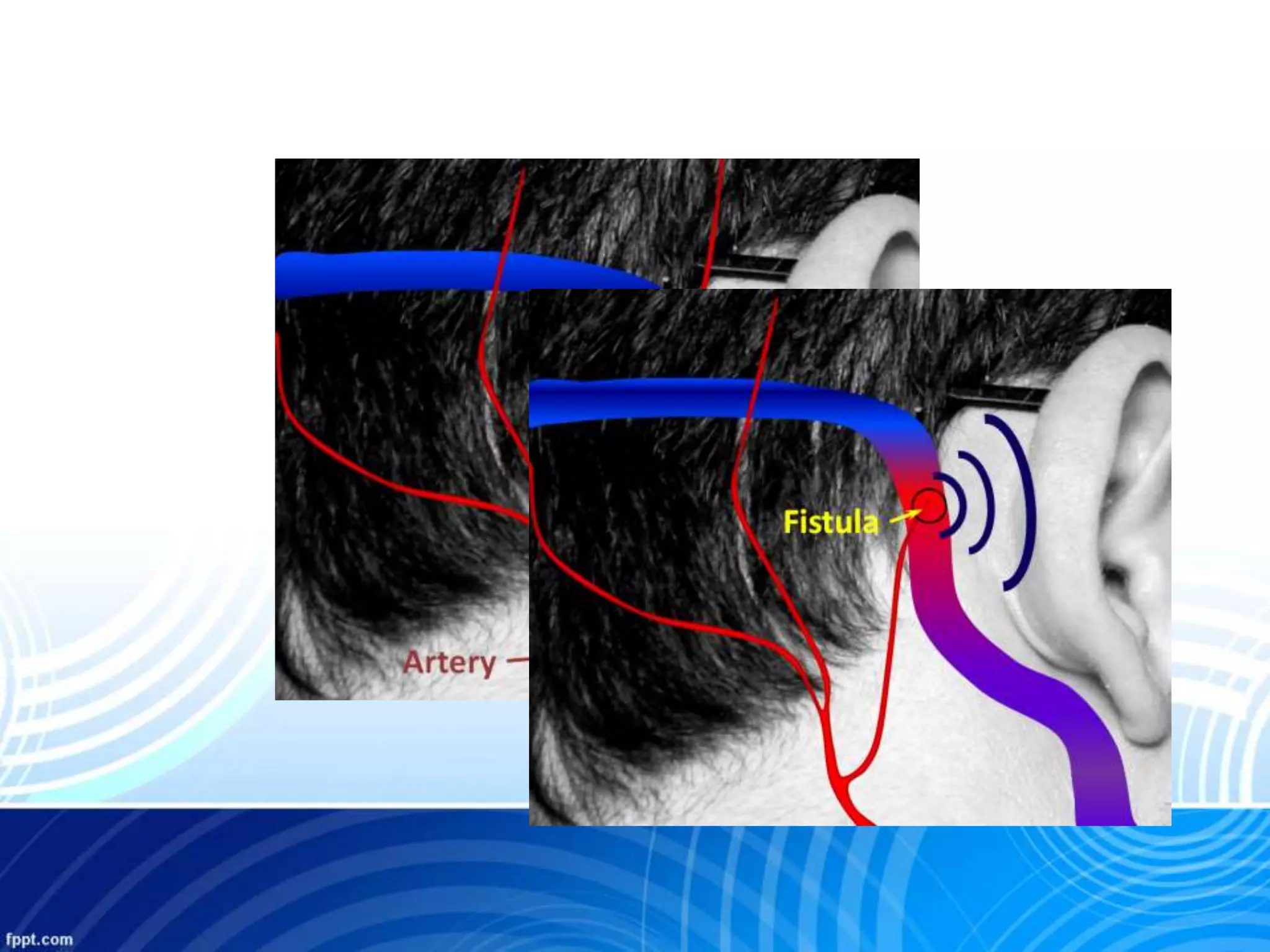 Dural arteriovenous fistula & AVM | PPTX