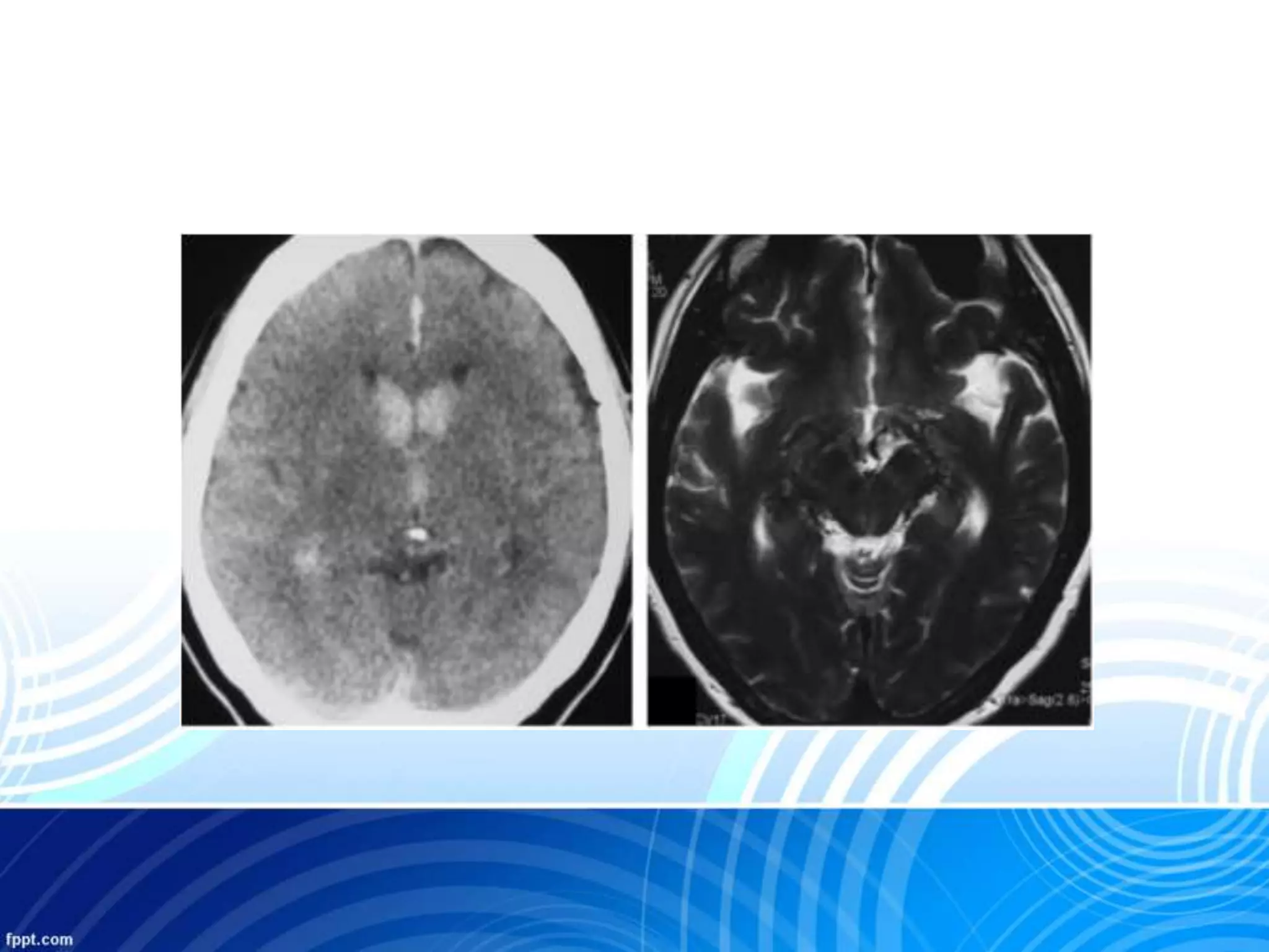 Dural arteriovenous fistula & AVM | PPTX