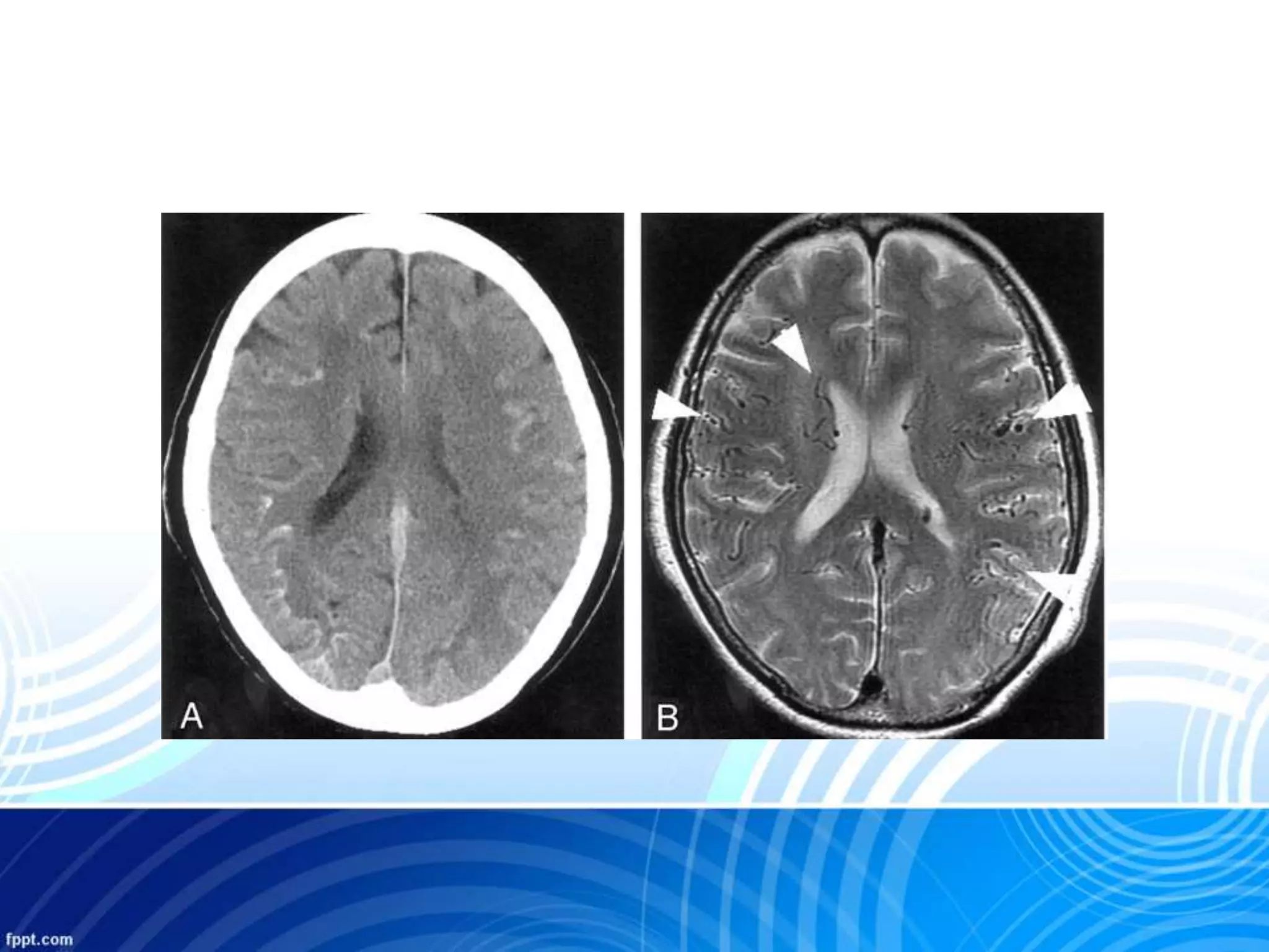 Dural arteriovenous fistula & AVM | PPTX
