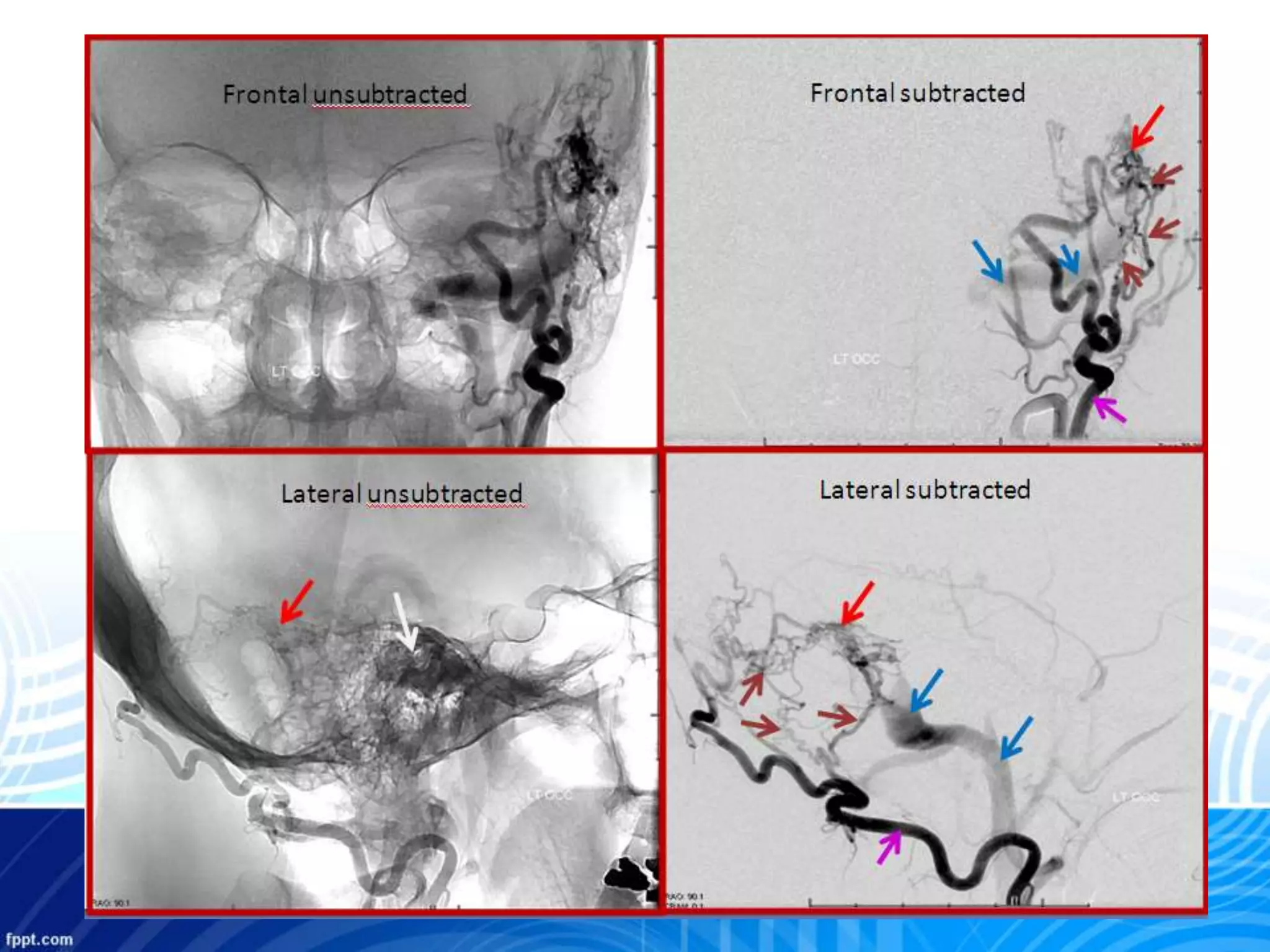 Dural arteriovenous fistula & AVM | PPTX | Blood Disorders | Diseases and Conditions