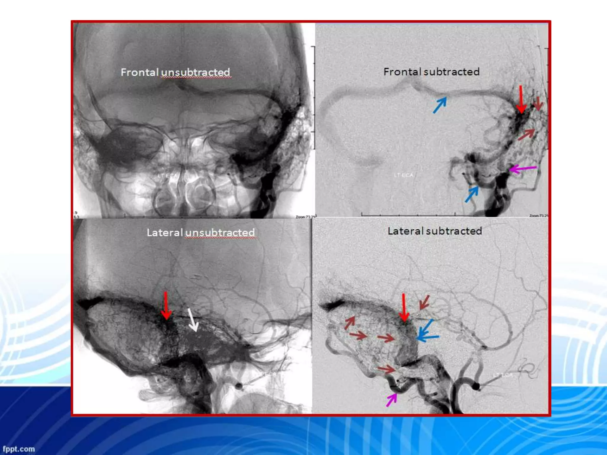 Dural arteriovenous fistula & AVM | PPTX
