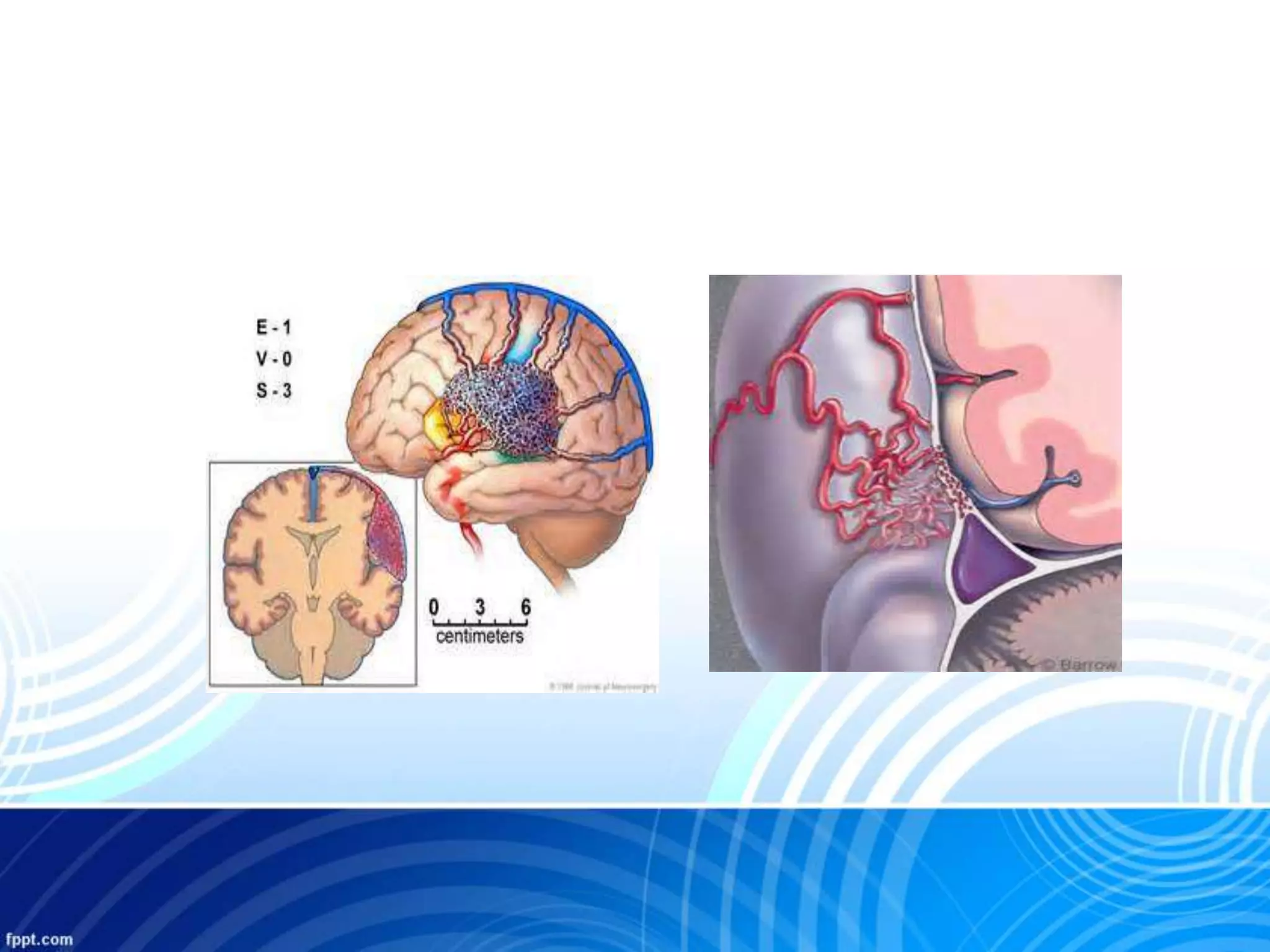 Dural arteriovenous fistula & AVM | PPTX