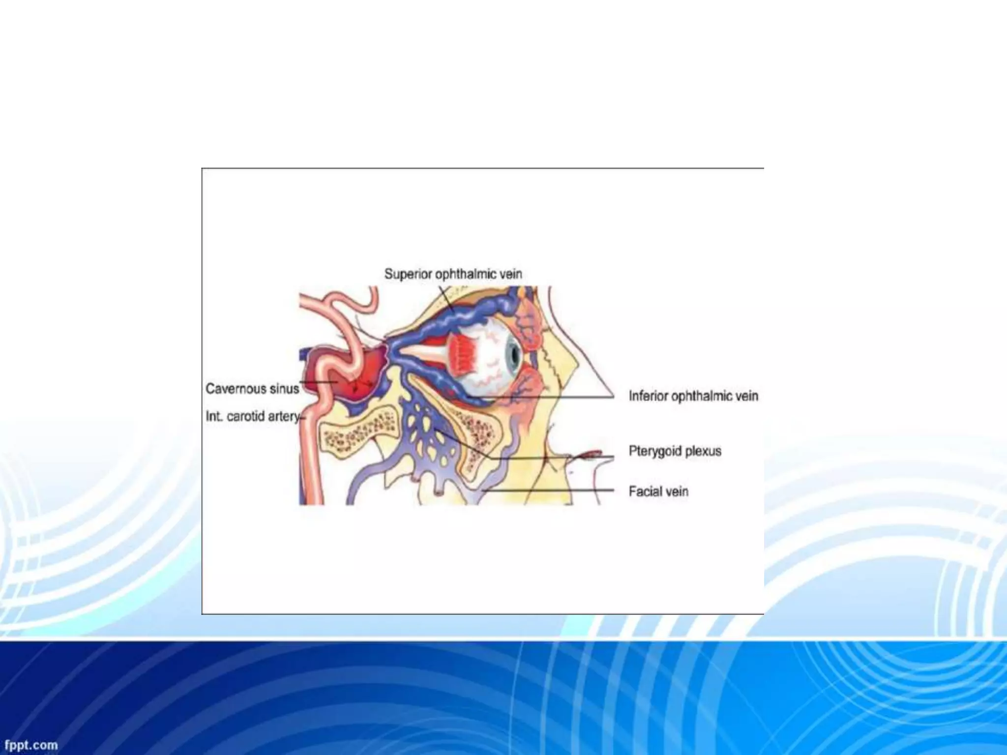 Dural arteriovenous fistula & AVM | PPTX
