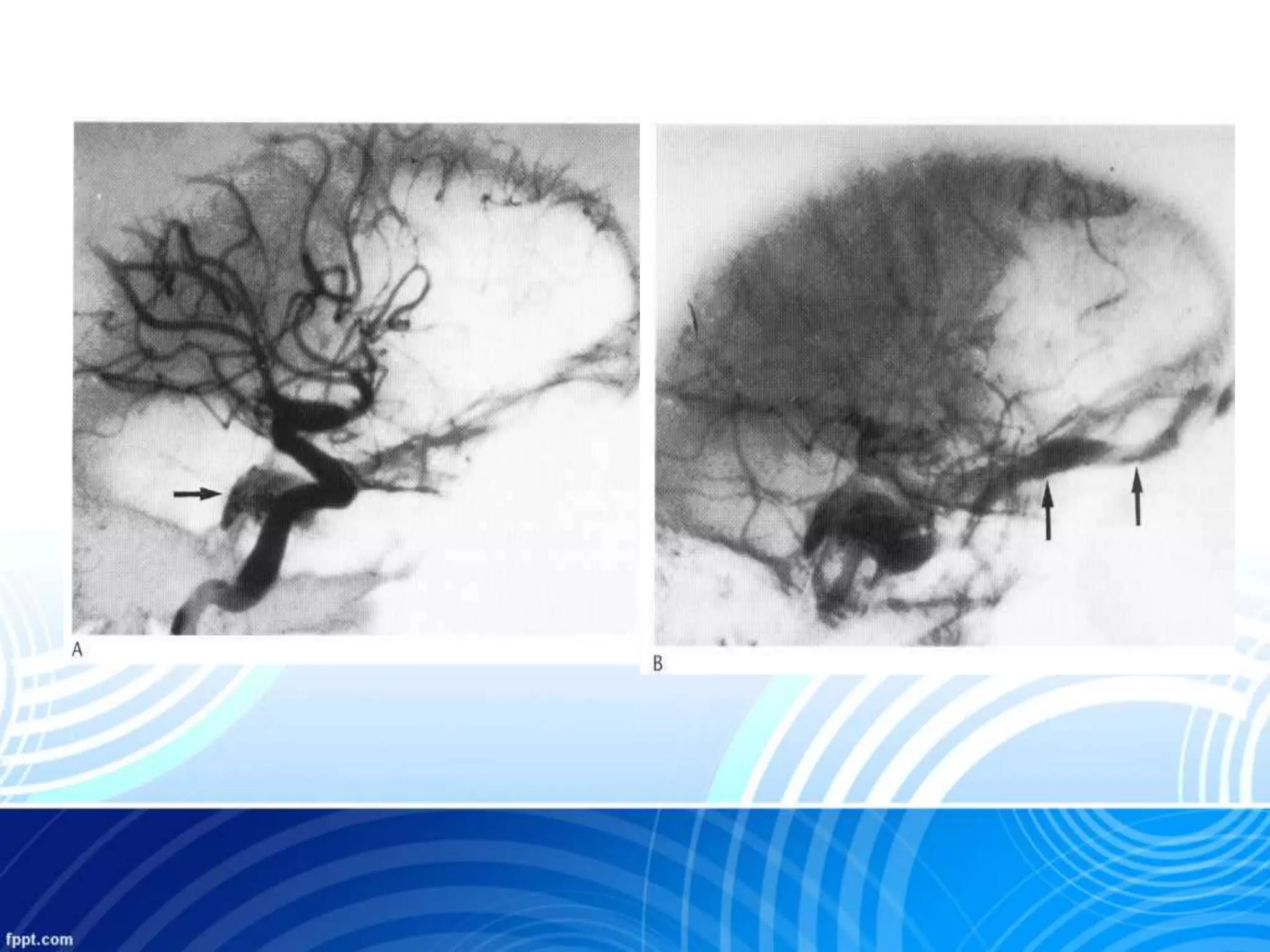 Dural arteriovenous fistula & AVM | PPTX | Blood Disorders | Diseases and Conditions