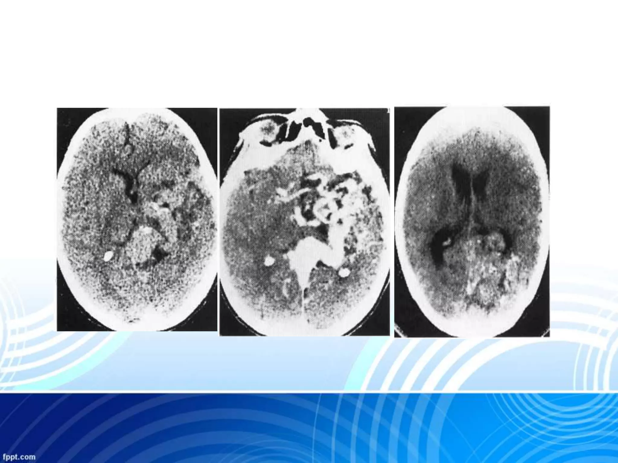 Dural arteriovenous fistula & AVM | PPTX
